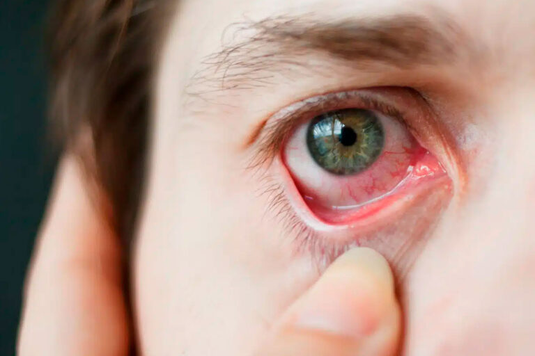 Conjuntivitis – alergoips.com