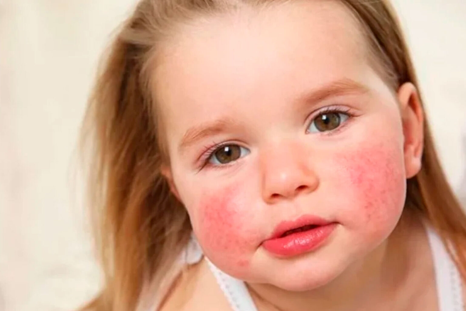 Dermatitis Atópica – alergoips.com